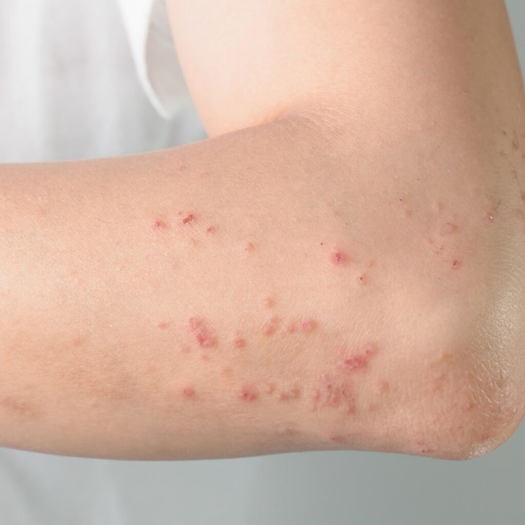 Dermatite Herpetiforme - Dra. Luana Meneghello | Dermatologista